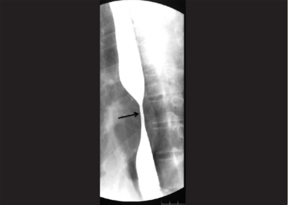 Oštećenje i nekroza jednjaka: Sve što moraš znati o trovanju kiselinom ...